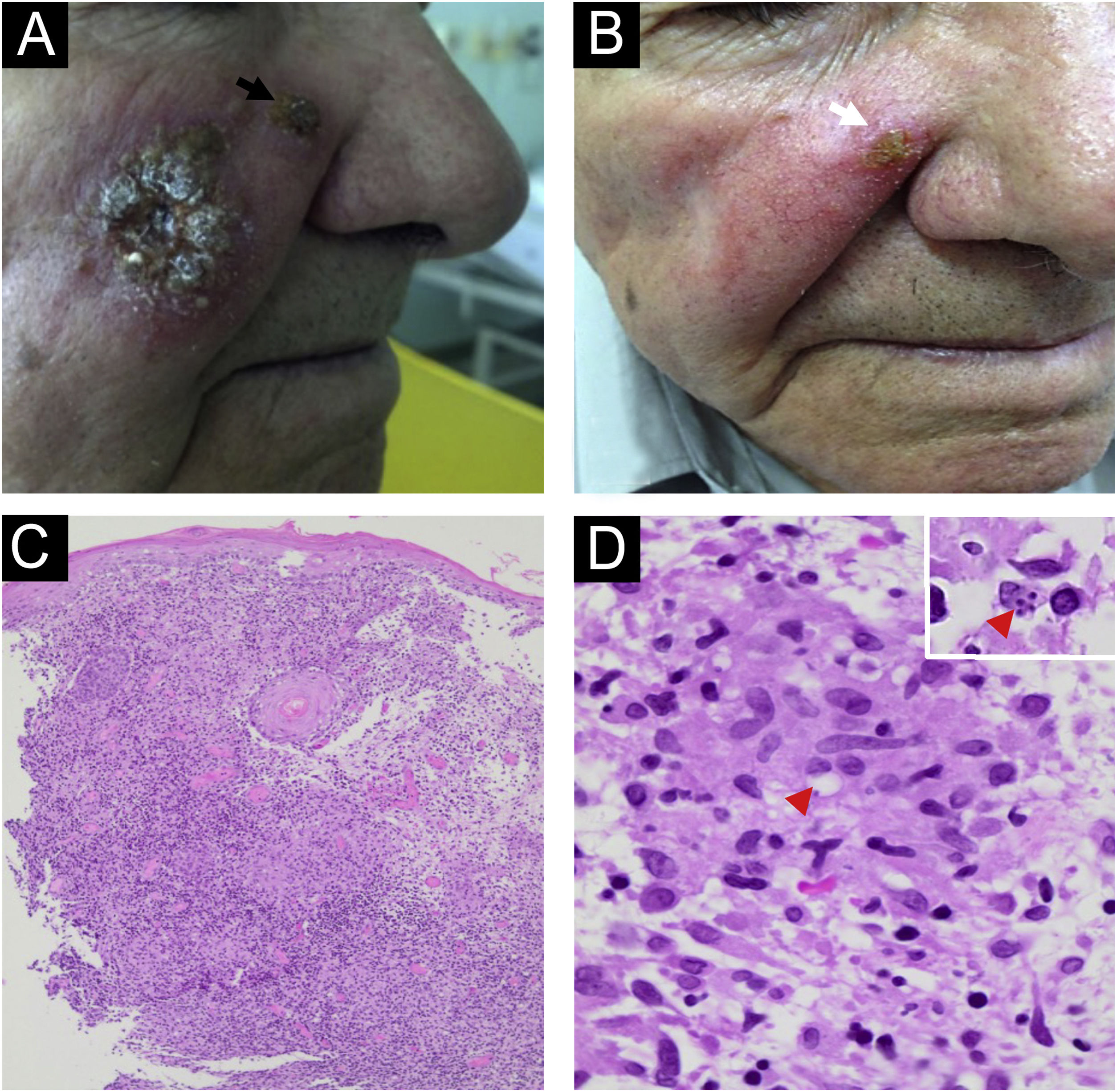 Cutaneous leishmaniasis on the malar region suggesting squamous cell ...
