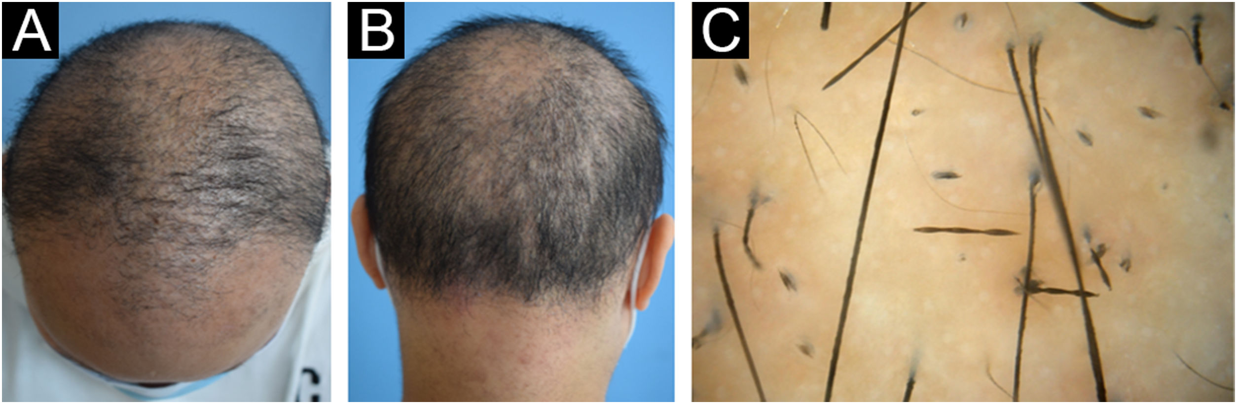 Autosomal dominant monilethrix with incomplete penetrance due to a ...