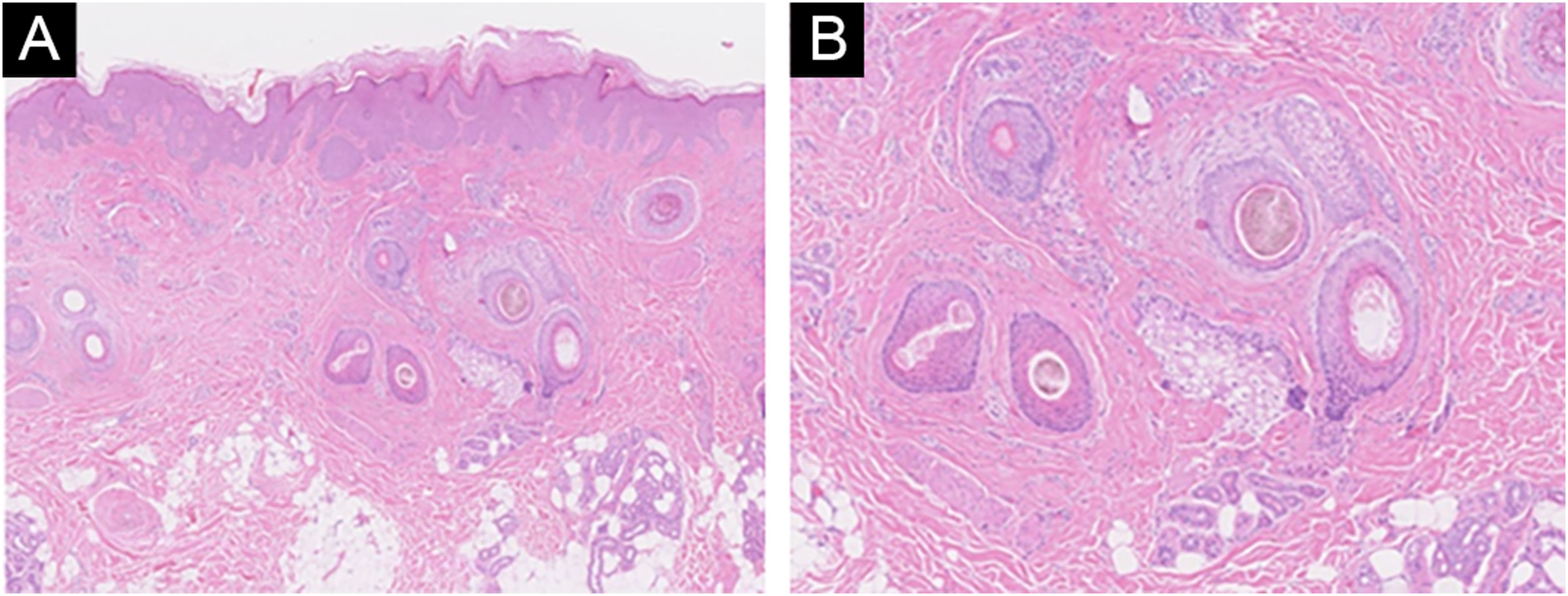 Autosomal dominant monilethrix with incomplete penetrance due to a ...