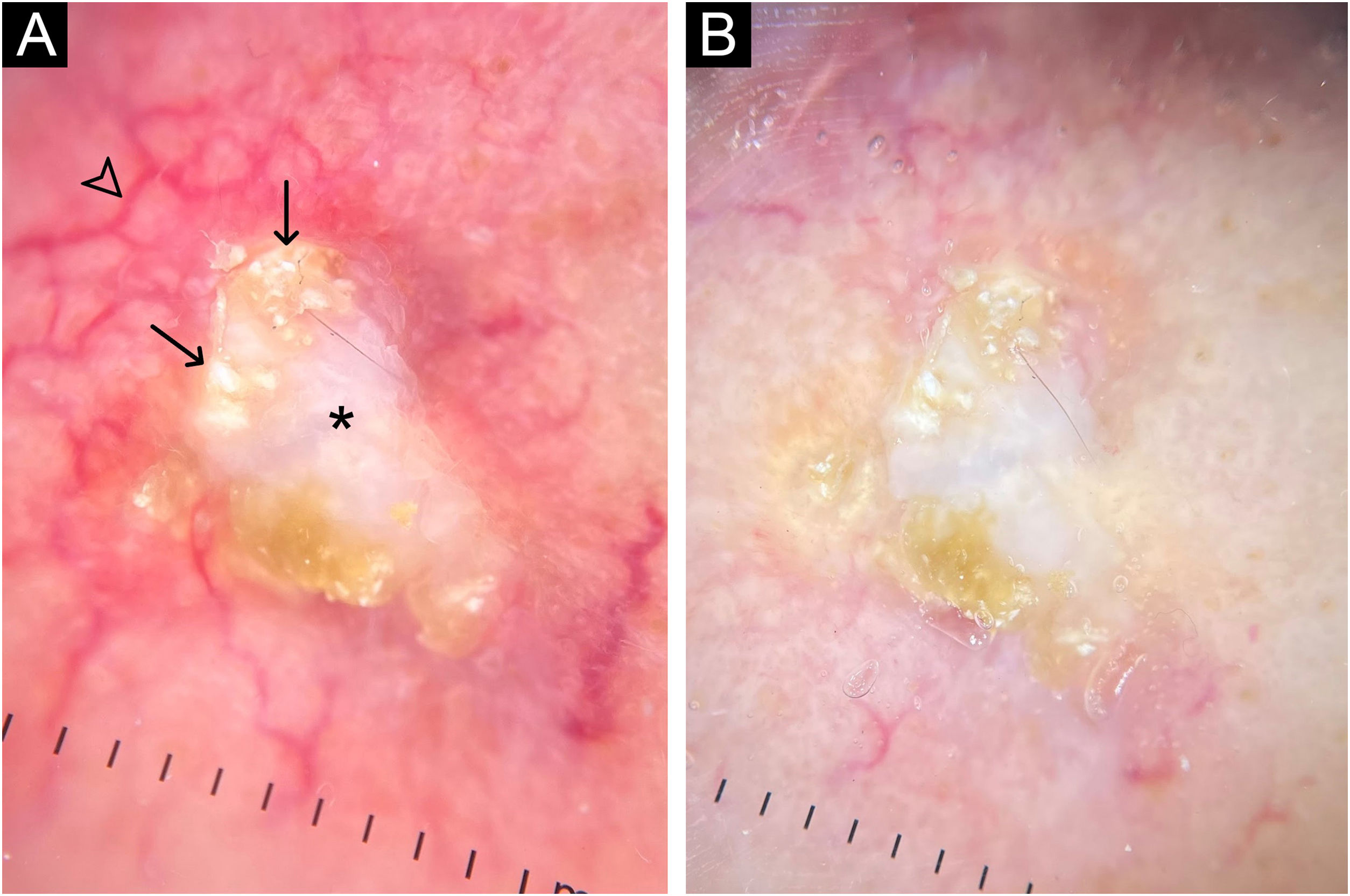 Dermoscopy of nasal and auricular gouty tophi | Anais Brasileiros de ...