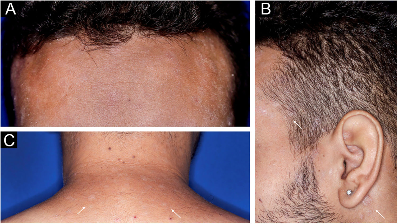collarette scale syphilis