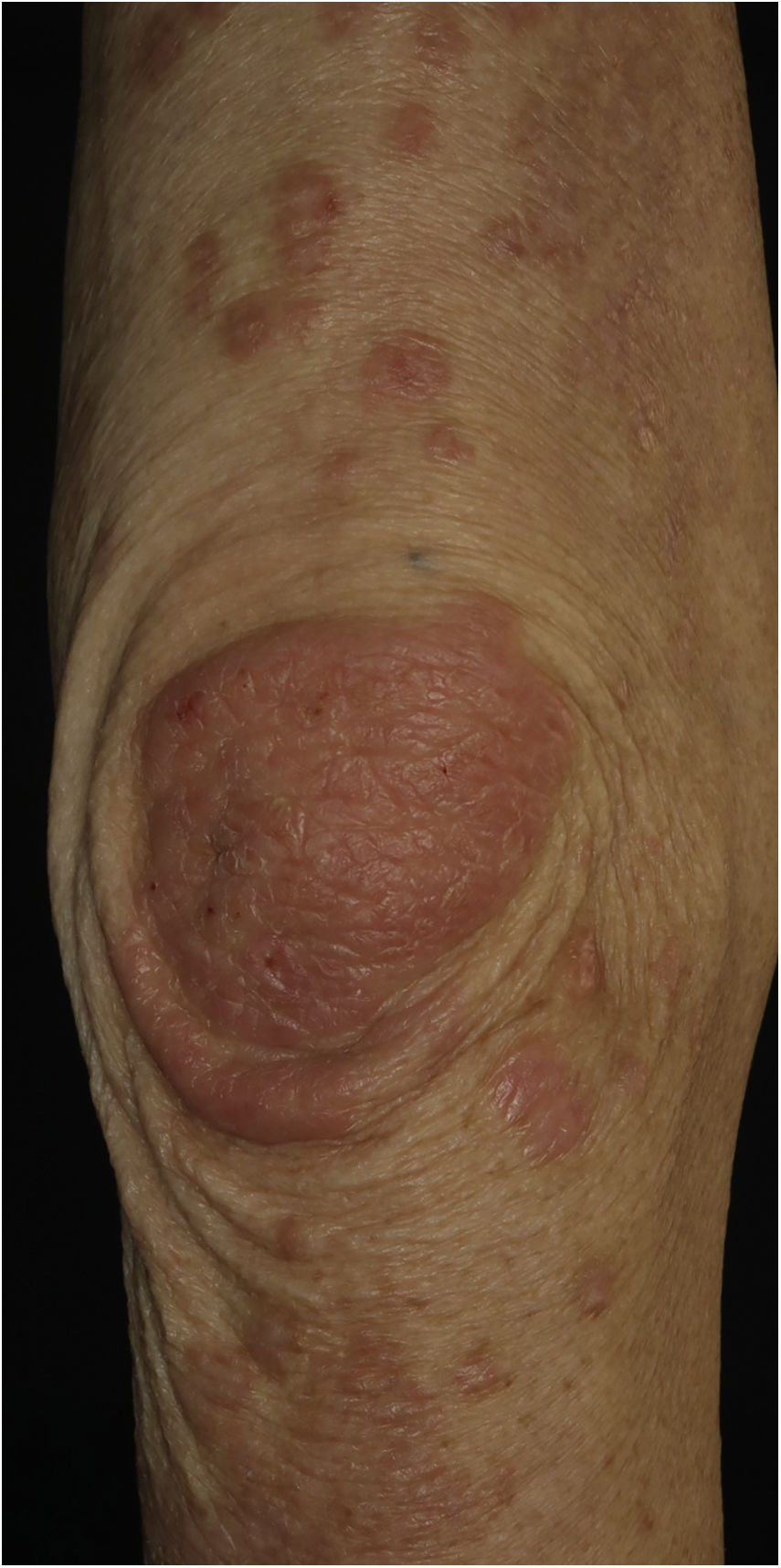 Psoriasiform rash following maculopapular eruption during the continued ...