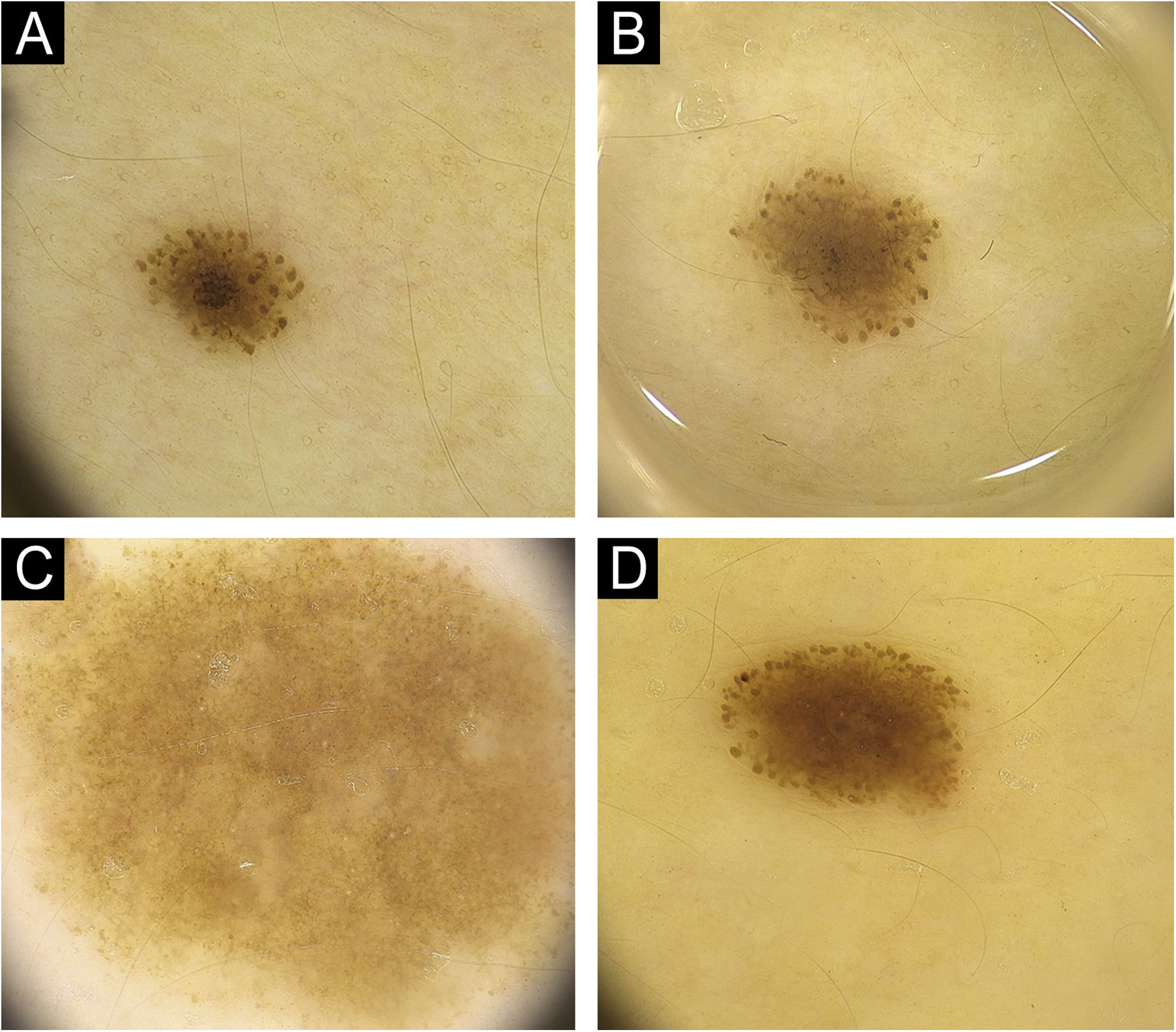 Dermoscopic monitoring of pediatric melanocytic nevi regarding pattern ...