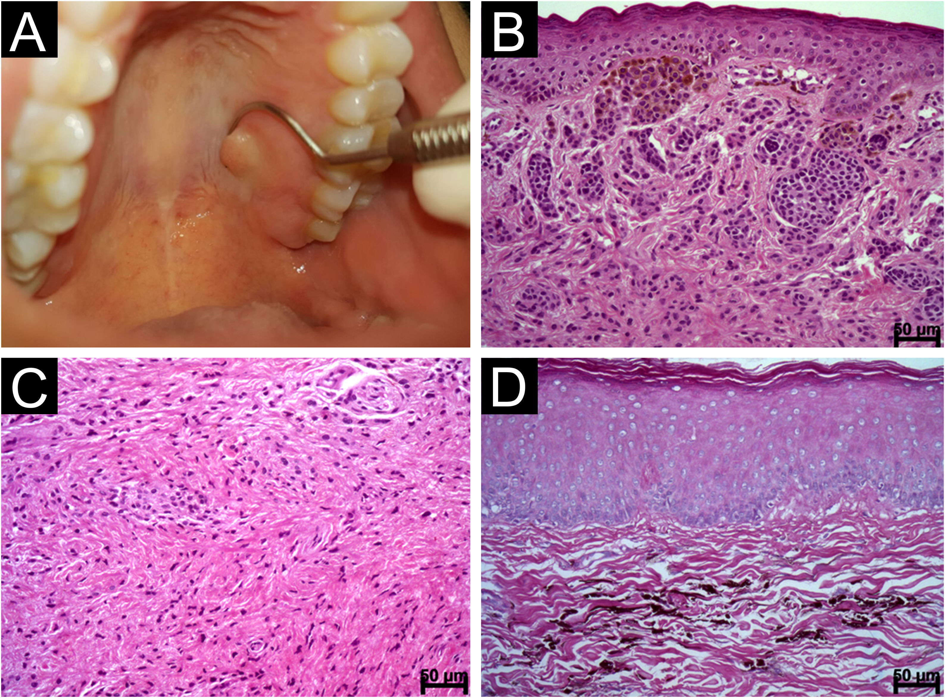 Melanocytic nevi and melanomas of the oral mucosa: detailed description ...