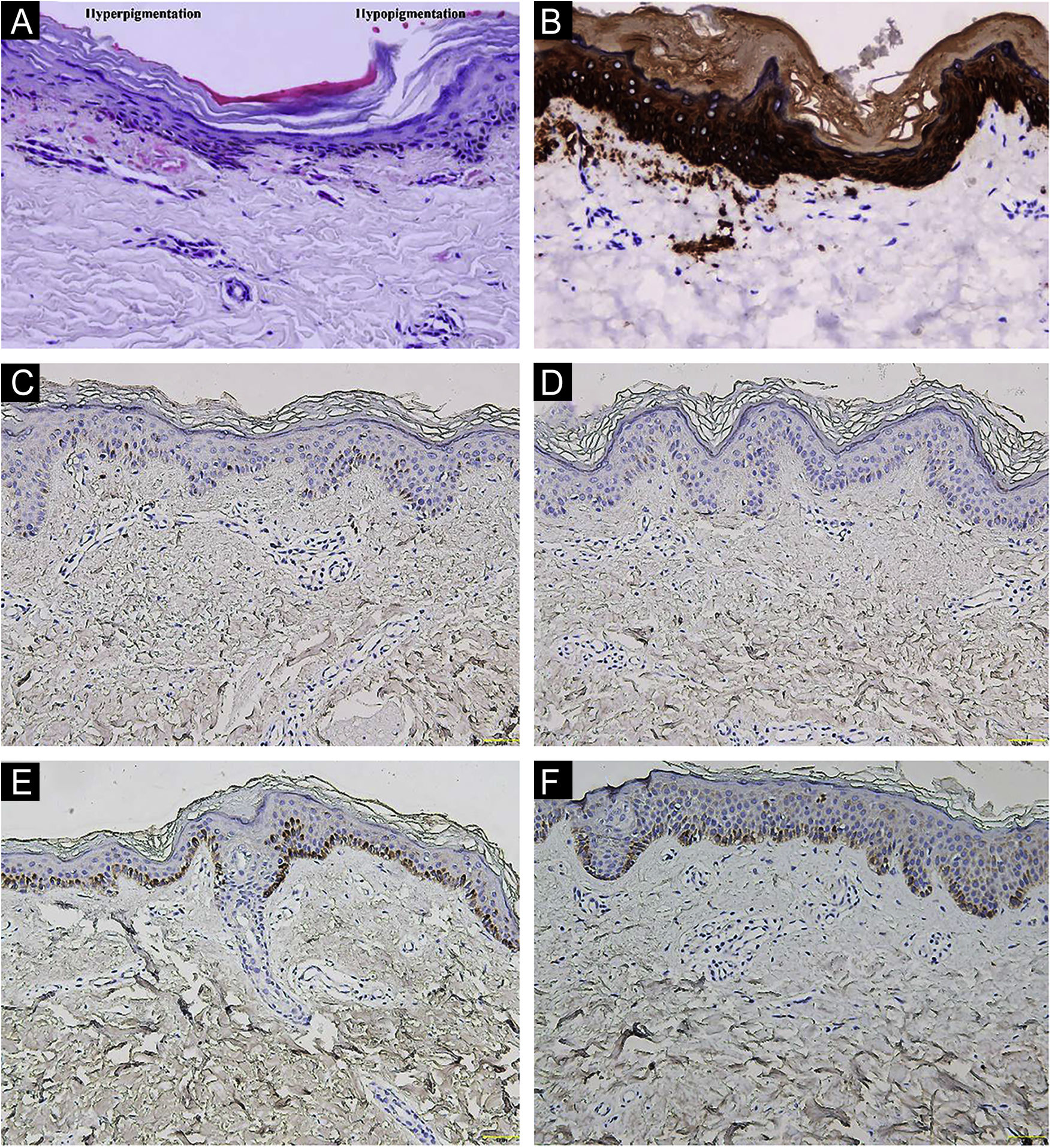 Amyloidosis cutis dyschromica caused by compound heterozygous GPNMB ...