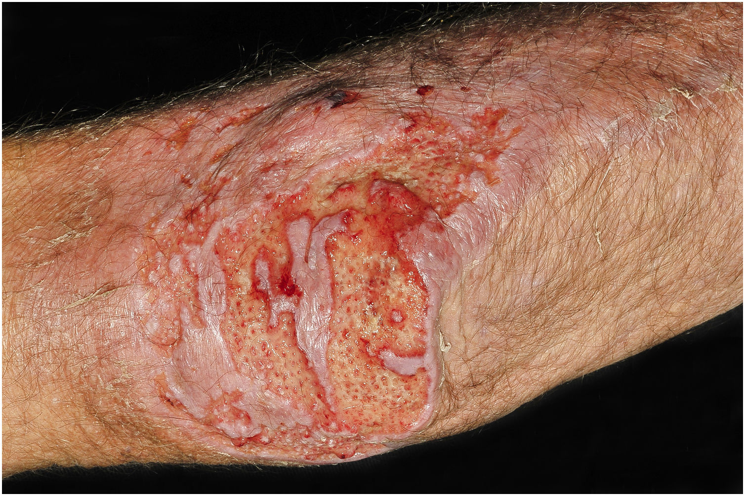 cryptococcus infection skin