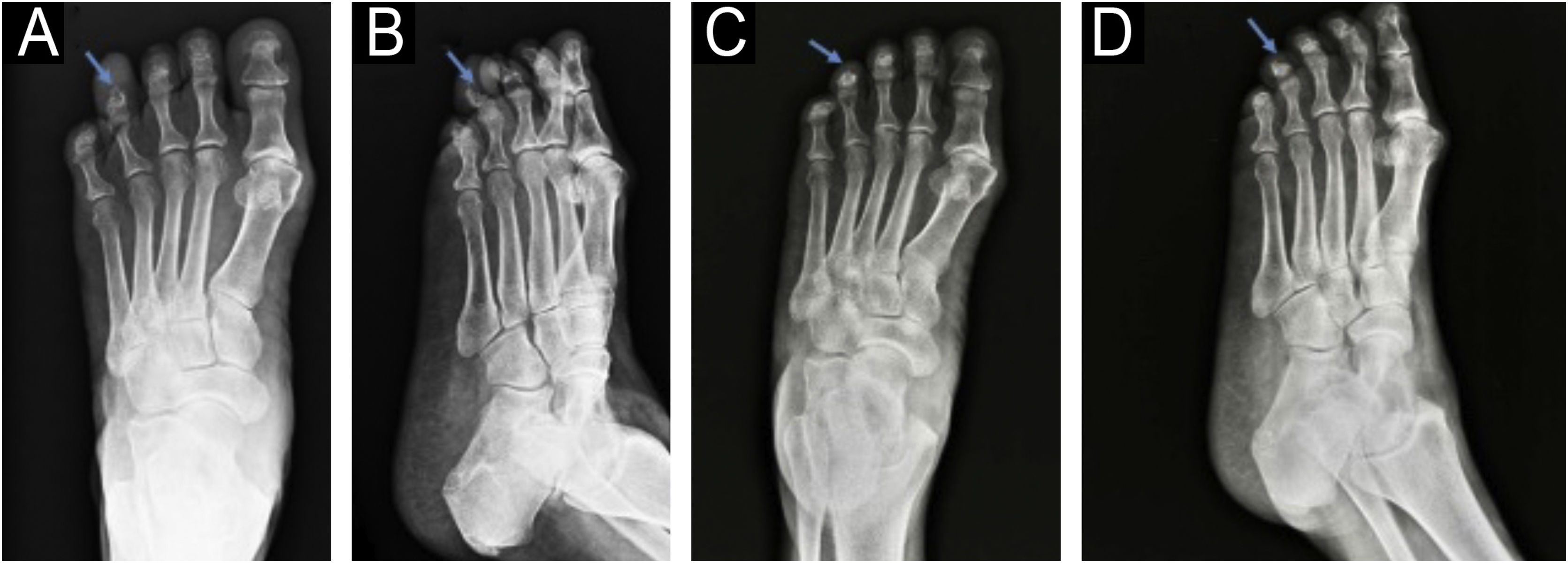 Superficial acral fibromyxoma with bone involvement: description and ...