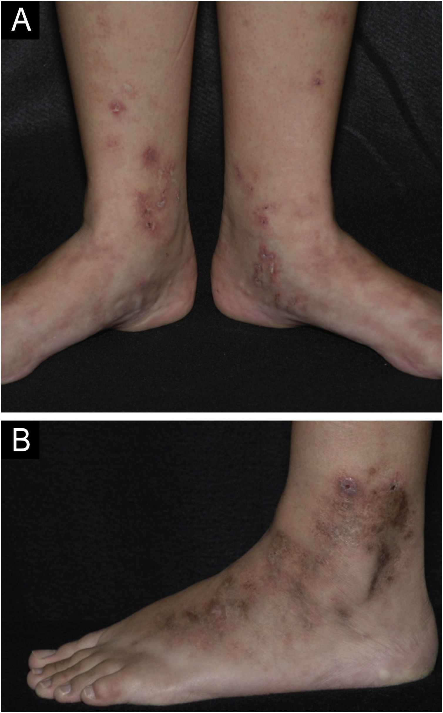 Livedoid vasculopathy, calciphylaxis, and Martorell’s hypertensive ...