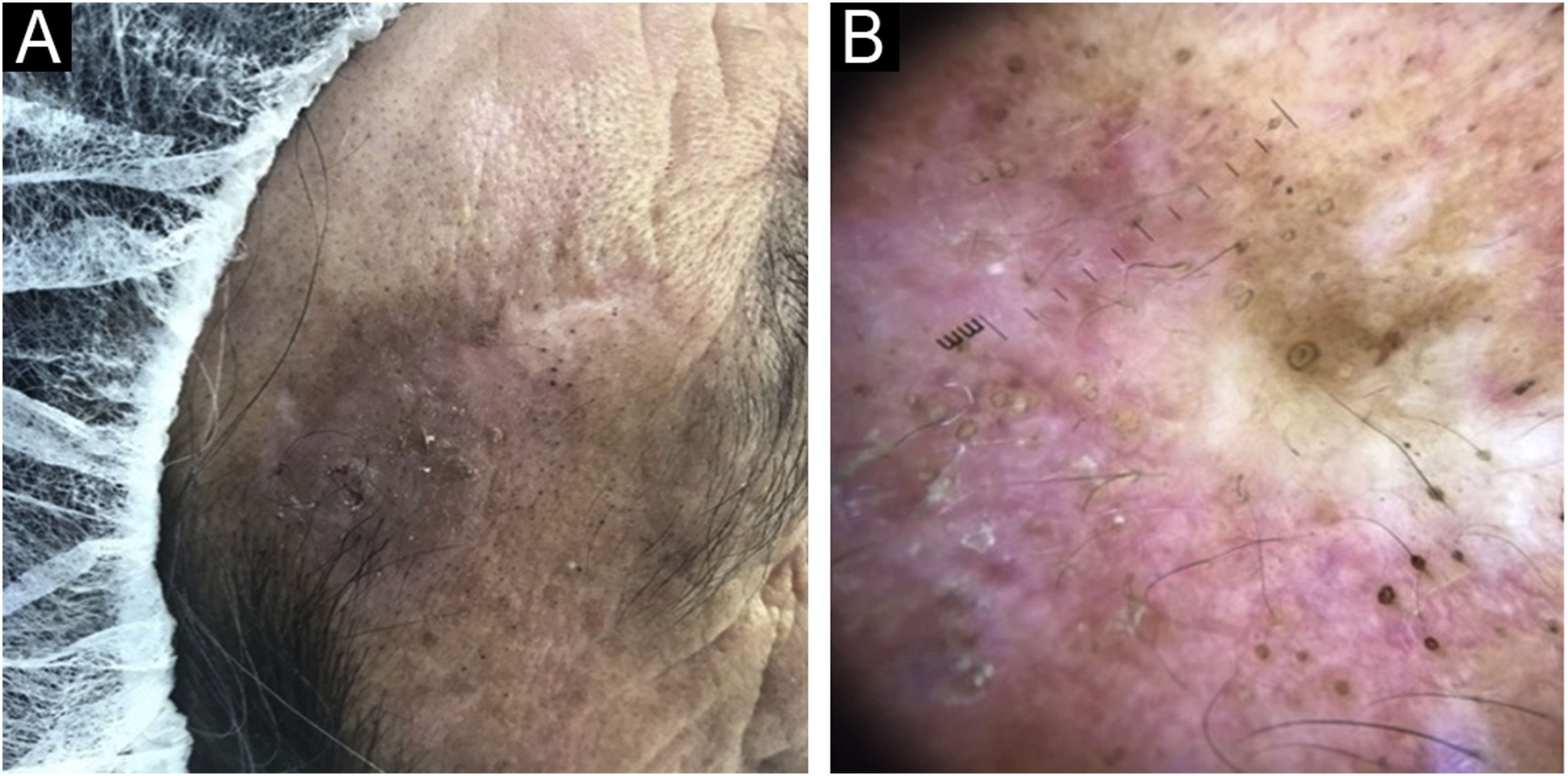 Facial pemphigus vegetans mimicking squamous cell carcinoma: when ...