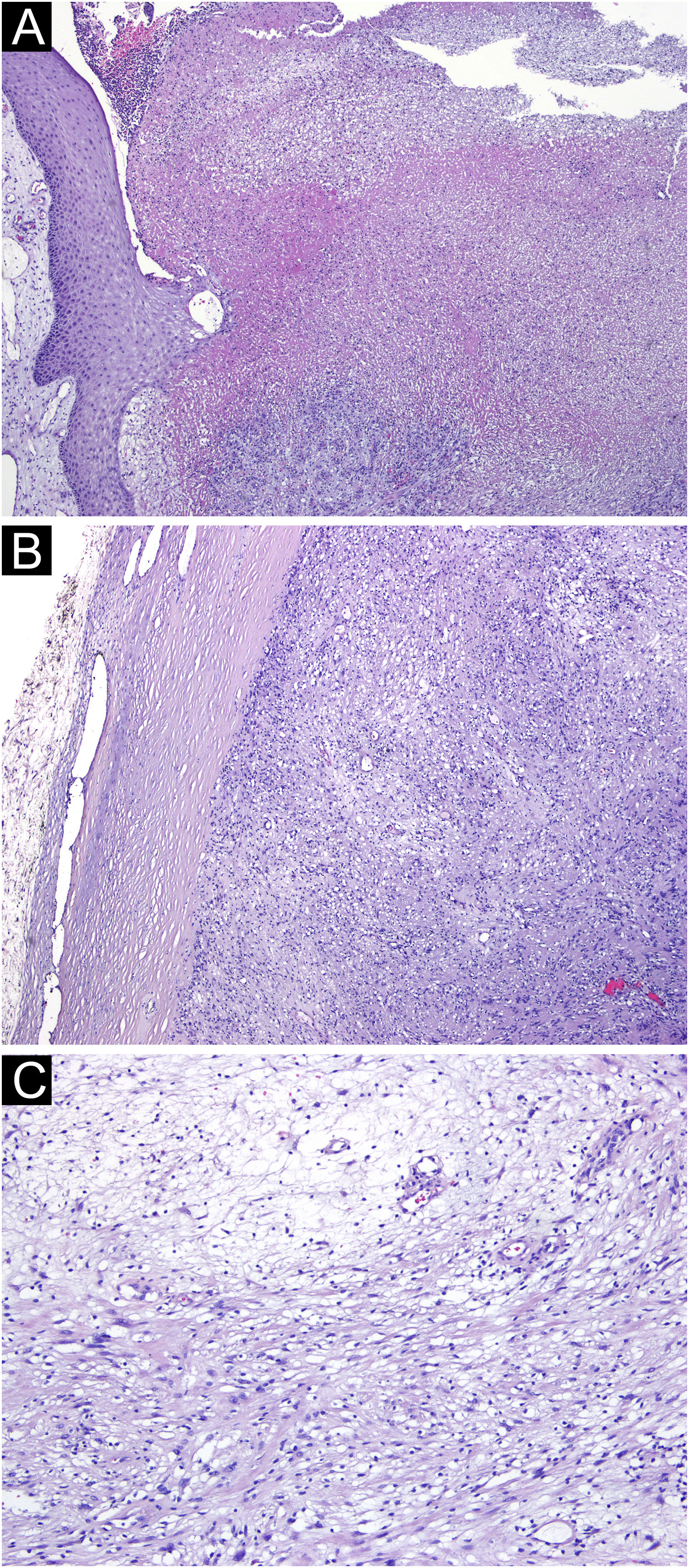 Atypical presentation of Schwannoma mimicking squamous cell carcinoma ...
