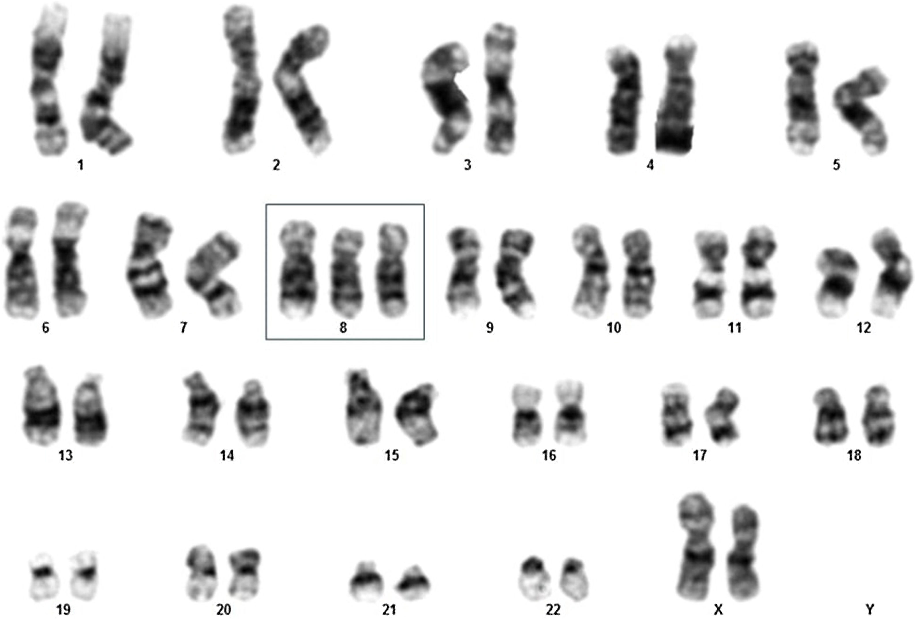 Pyoderma gangrenosum diagnosed in a high-risk myelodysplastic neoplasm ...