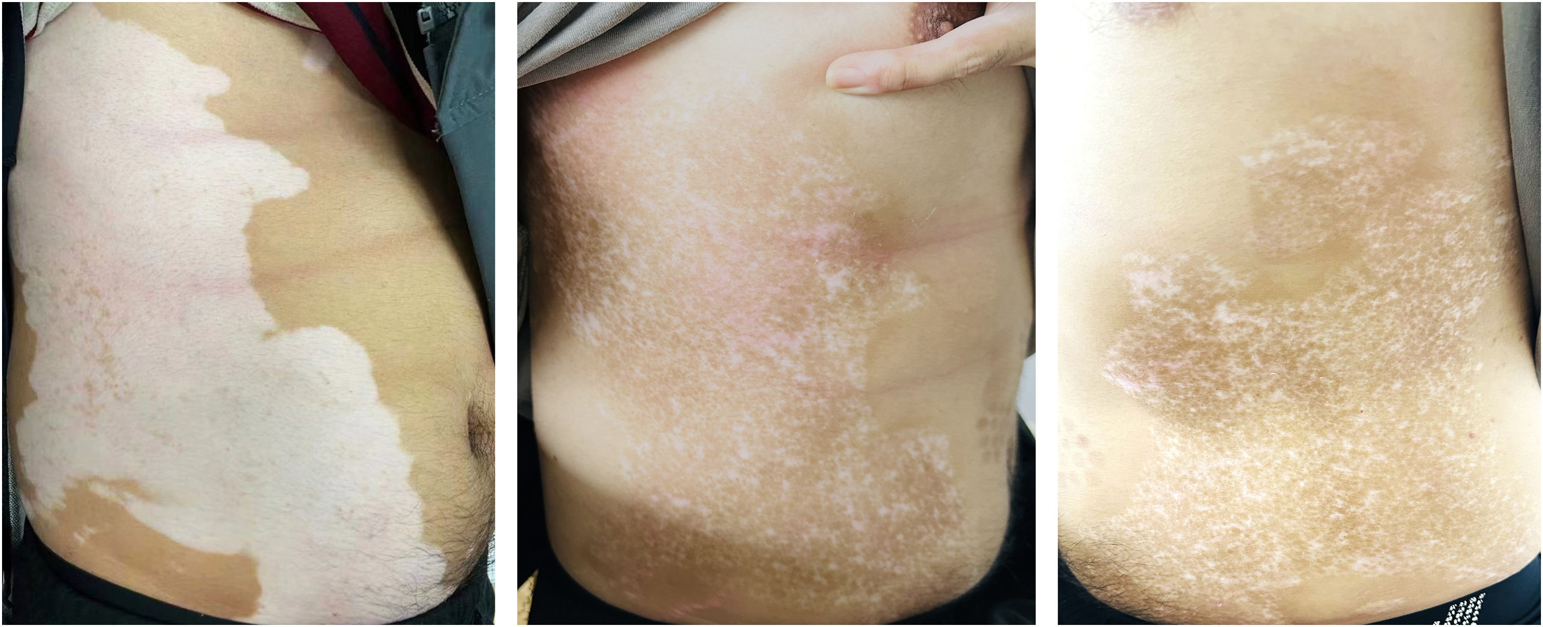 Successful repigmentation with ritlecitinib and combined home-based phototherapy in an ...
