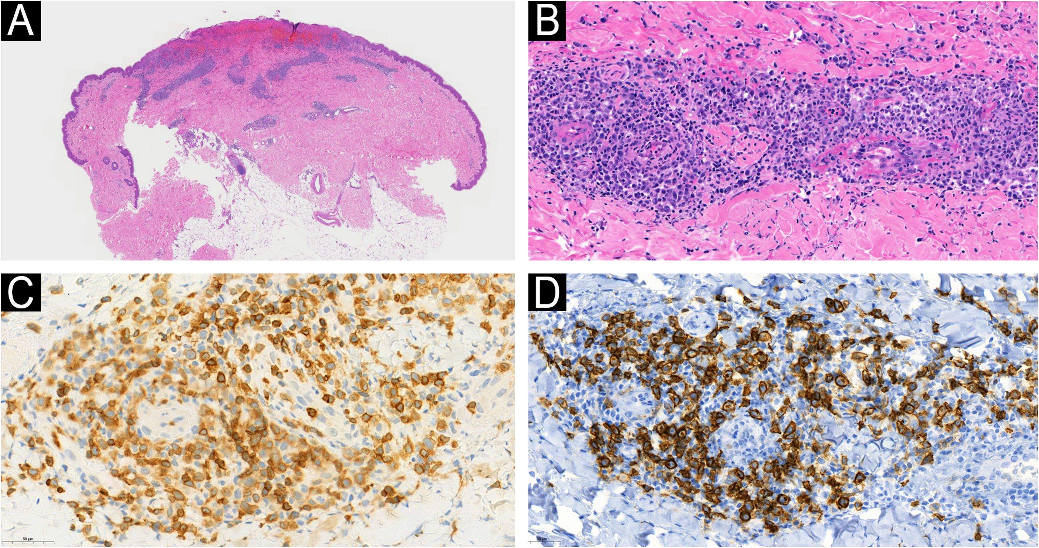 Rare case of lymphomatoid papulosis type E | Anais Brasileiros de ...