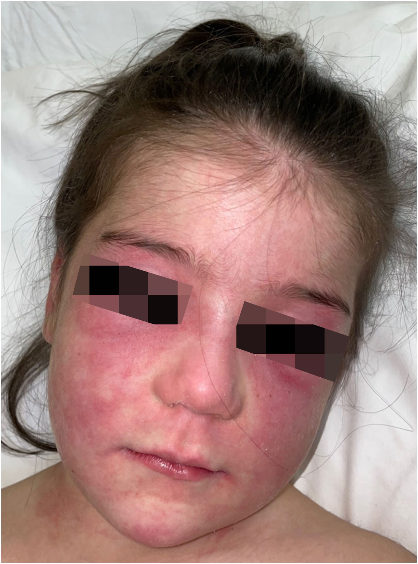 Long-term outcome of juvenile dermatomyositis associated with ...