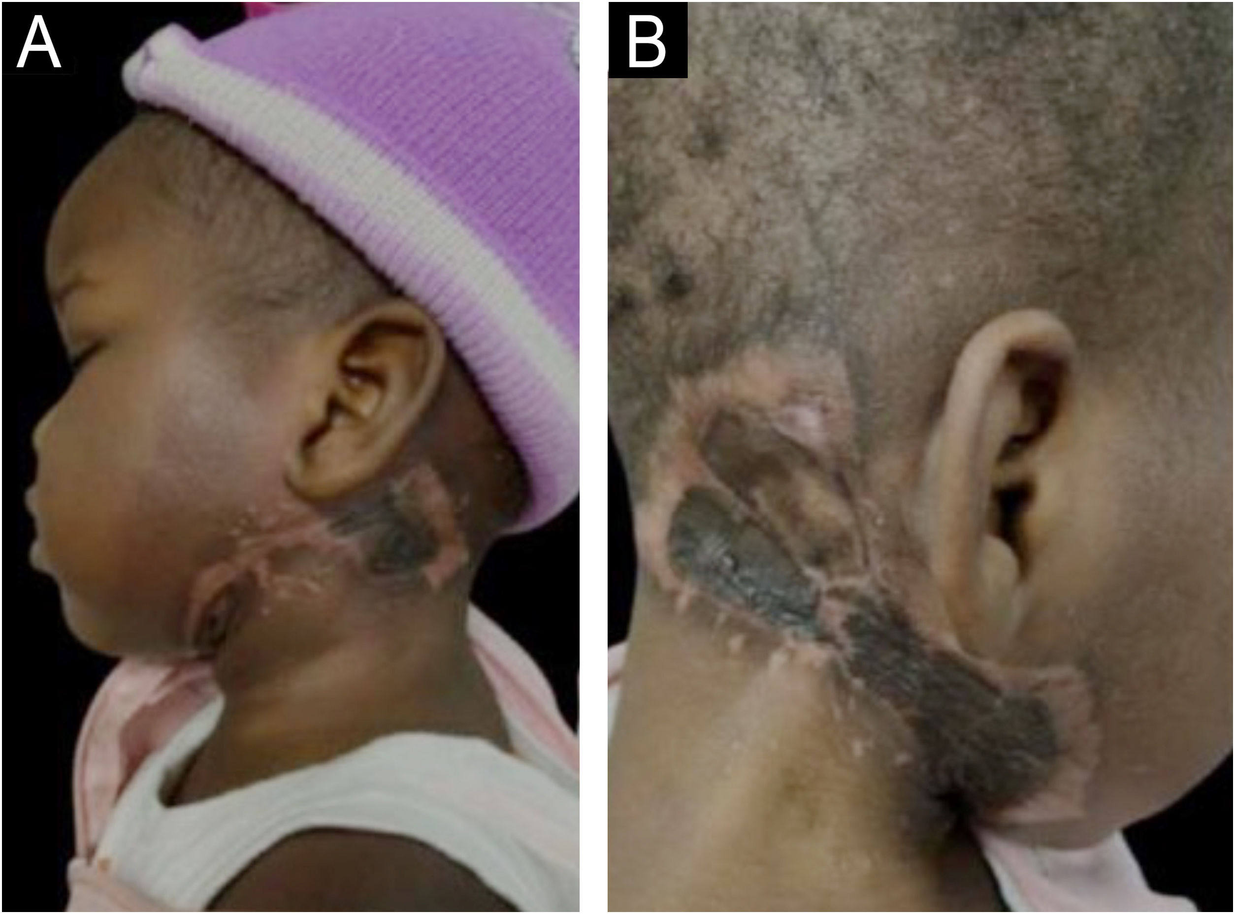 Necrotizing fasciitis caused by Stenotrophomonas maltophilia on the ...