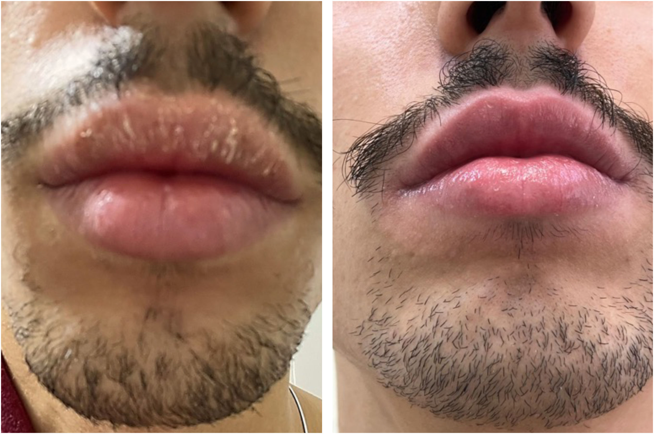 Epidemiological profile and main allergens identified in cases of ...