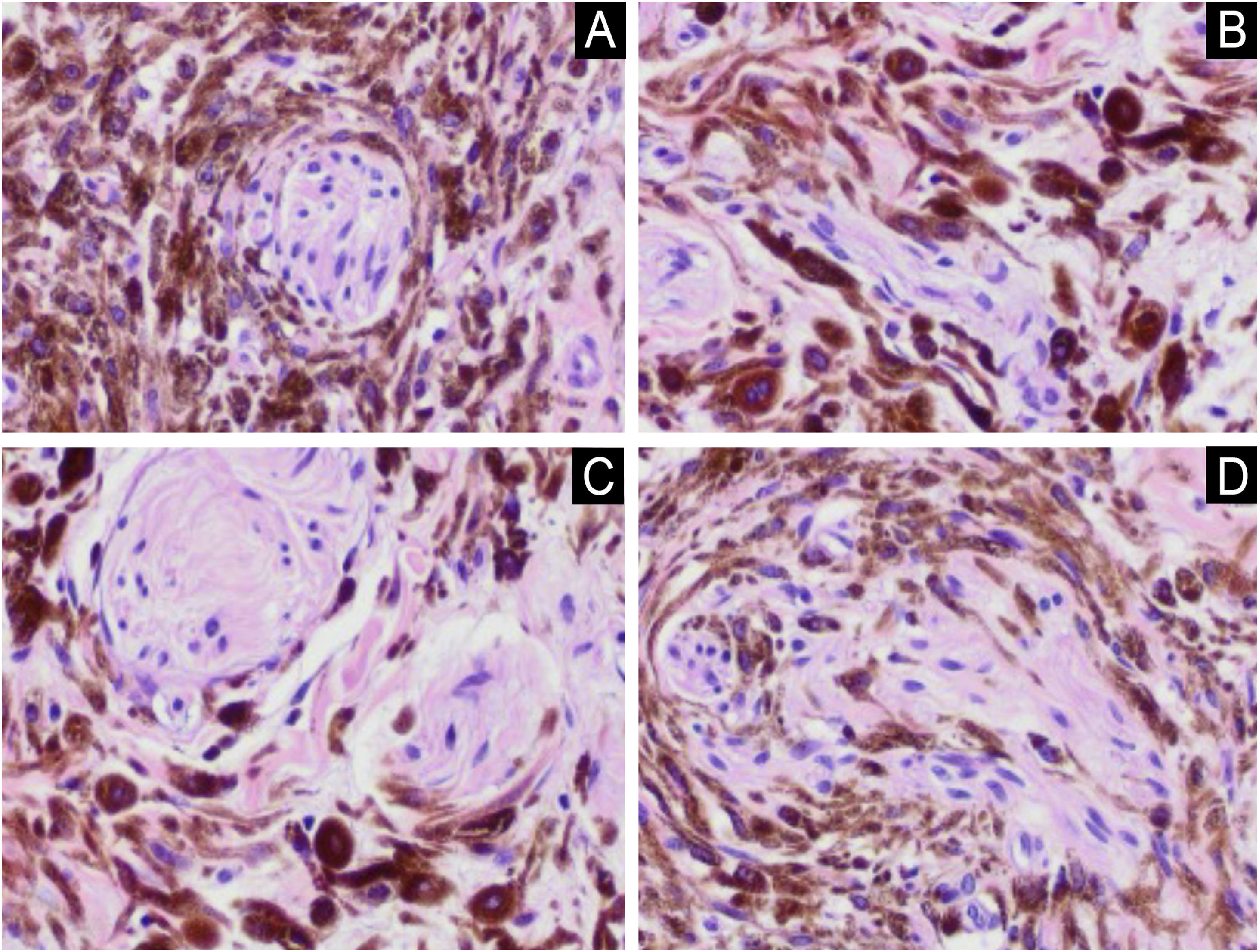 Dermoscopic rainbow pattern in malignant blue nevus | Anais Brasileiros ...