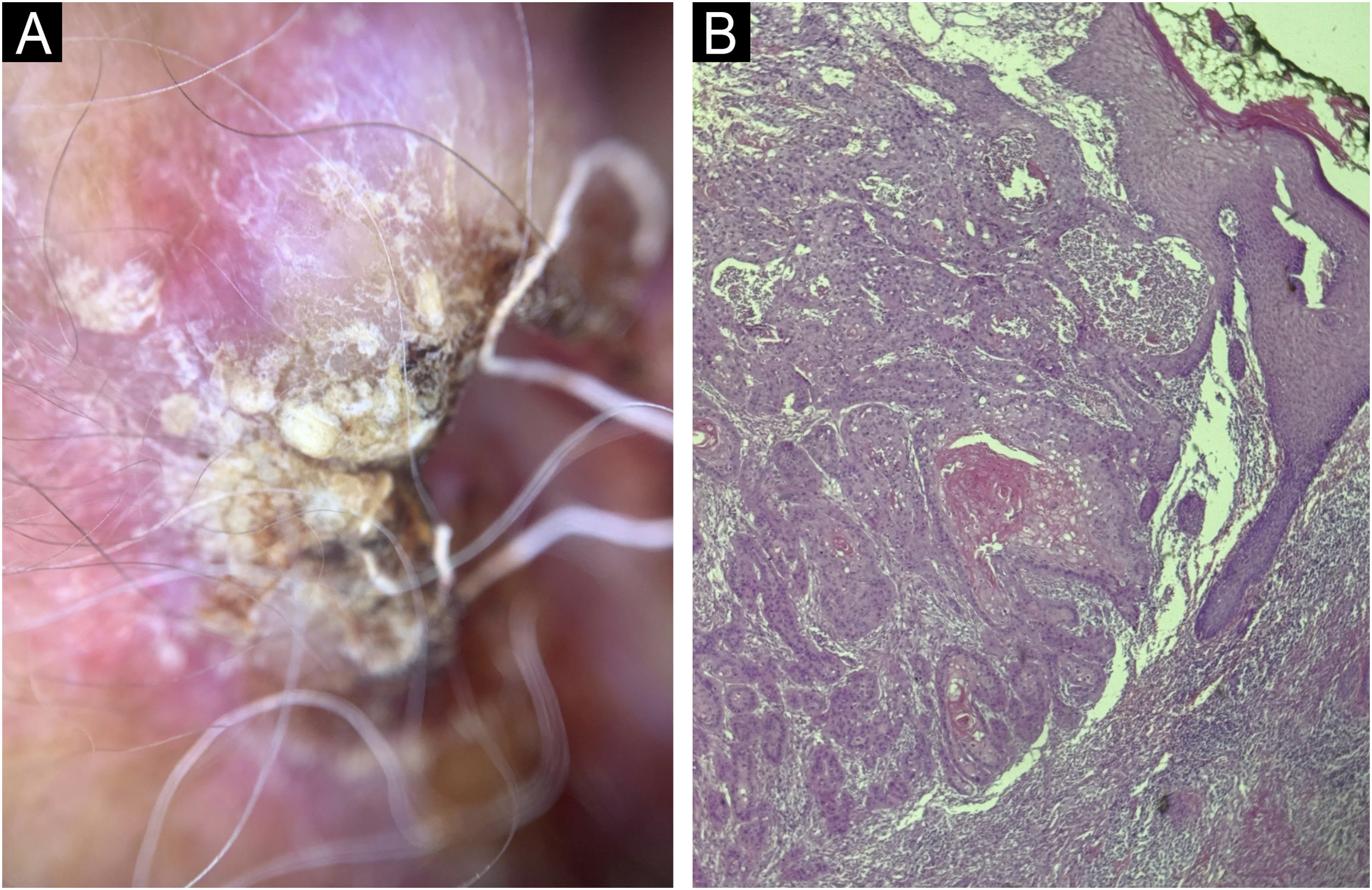 Cutaneous squamous cell carcinomas secondary to hydroxyurea: a case ...