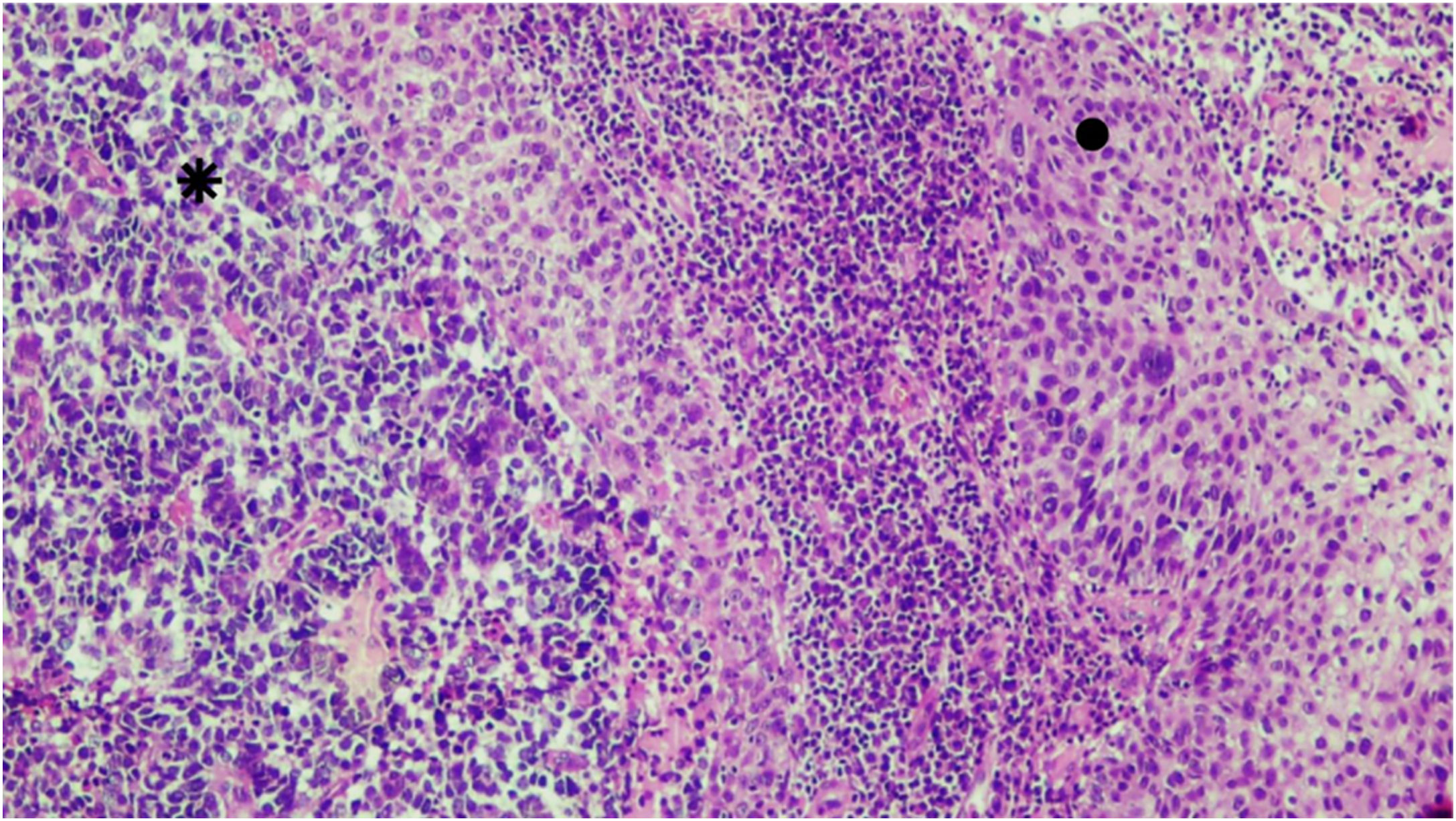 Merkel cell carcinoma coexisting with squamous cell carcinoma⋆