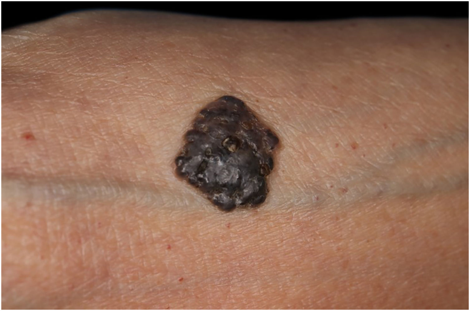 A case of labyrinthine pattern basal cell carcinoma | Anais Brasileiros ...