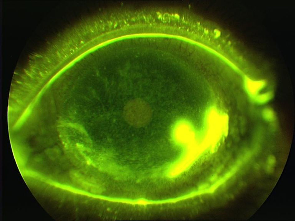 Endotelitis y trabeculitis herpética con afectación corneal tardía ...