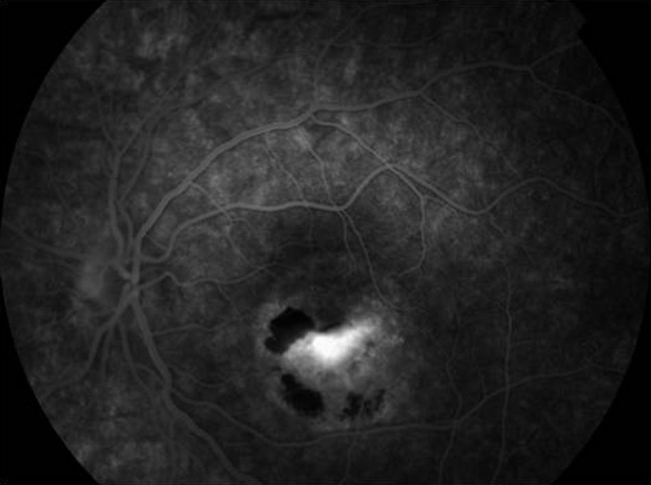 Distrofia macular viteliforme de Best asociada a neovascularización ...