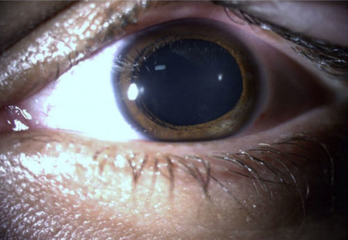 Neuropatía óptica traumática: ¿tratar o no tratar? A propósito de dos ...
