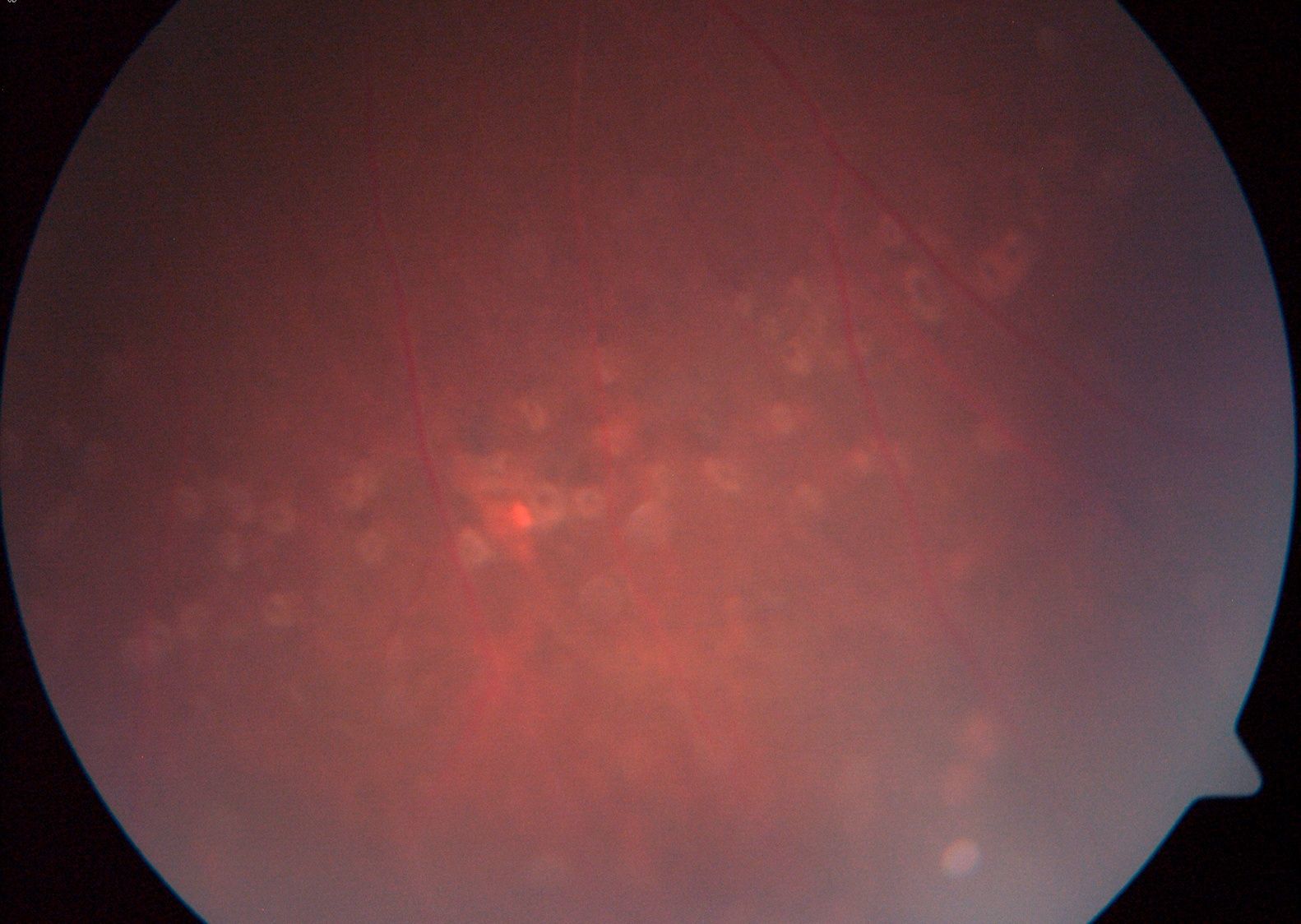 Pacientes con pars planitis tratados con fotocoagulación selectiva ...