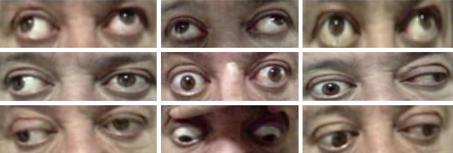 Síndrome de webino secundario a sífilis meningovascular. Una entidad ...