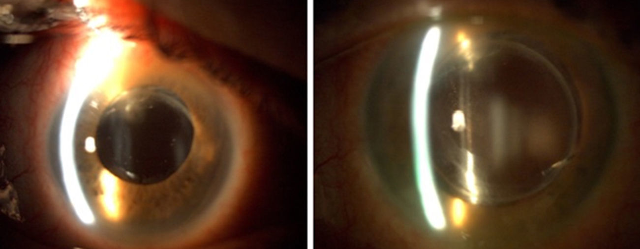 Síndrome uveítis-glaucoma-hipema asociado a hemorragia vítrea de ...