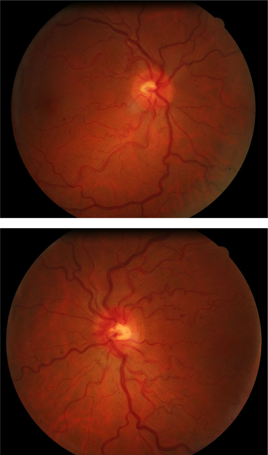 De la tortuosidad vascular fisiológica a la tortuositas vasorum retinae ...
