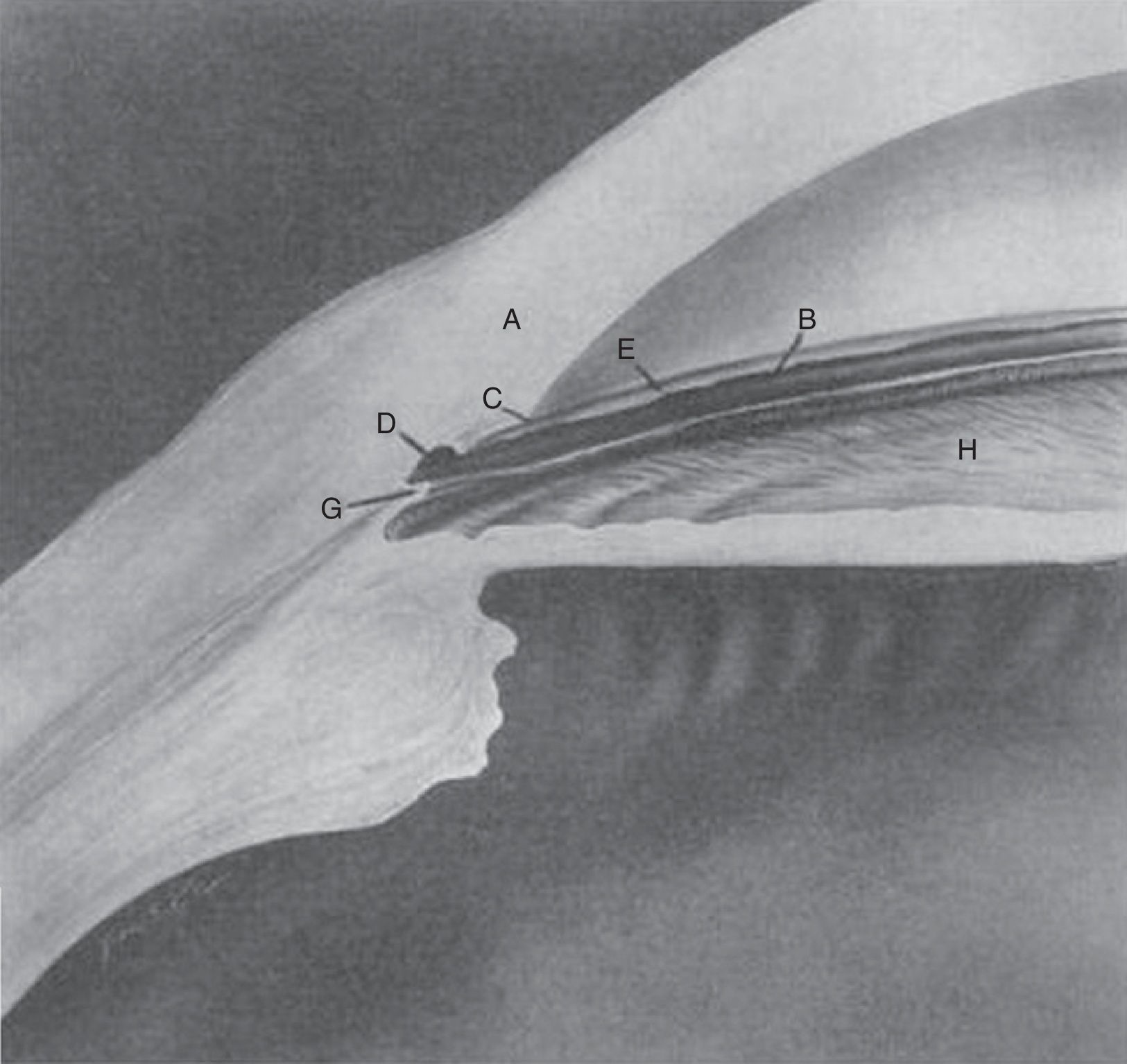 Historia de la cirugía del glaucoma (II): de la goniotomía a la primera ...
