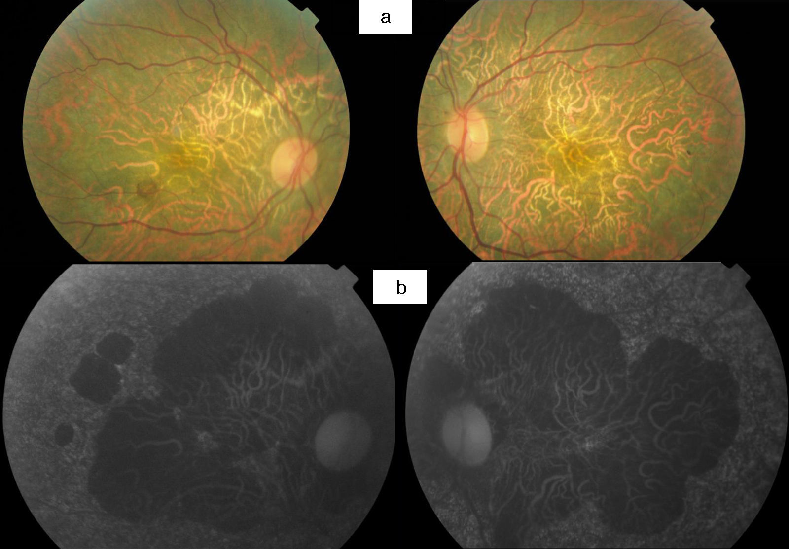 Dos hermanas con distrofia macular causada por la mutación 3243A>G del ...
