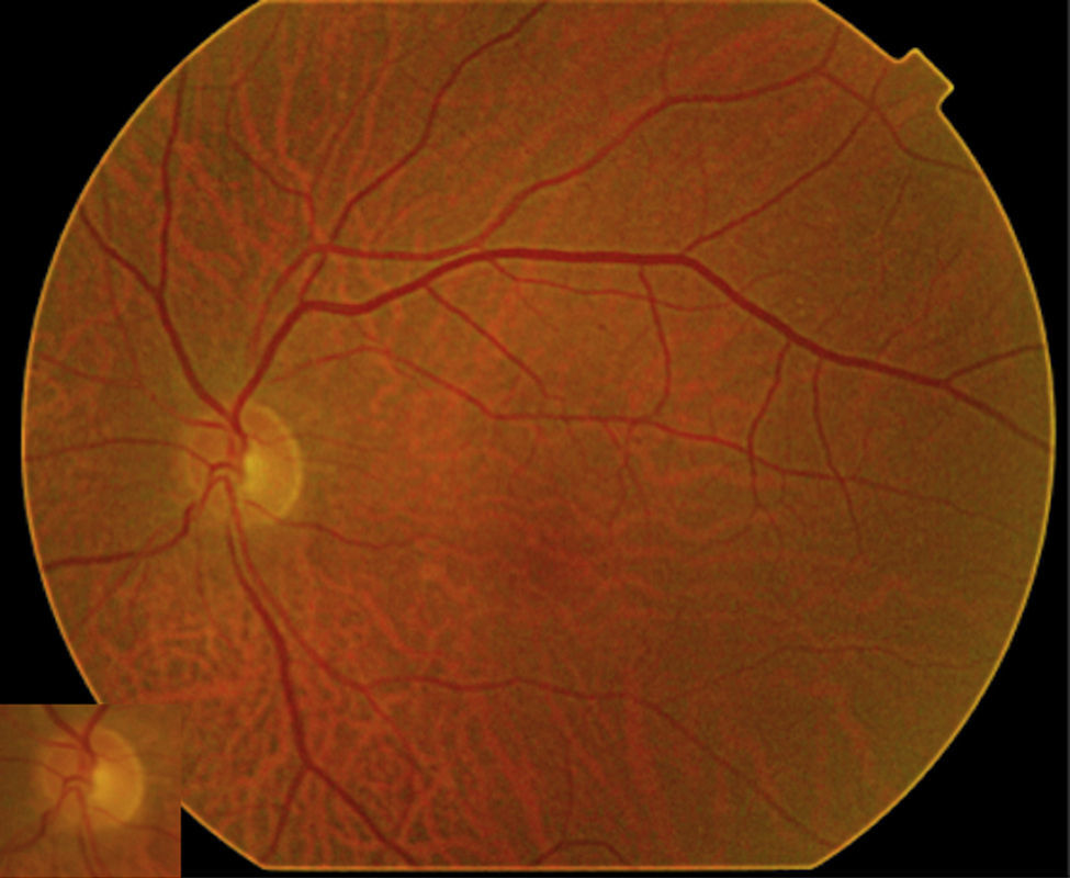 Oclusión de rama arterial retiniana en un paciente con ojo único ...