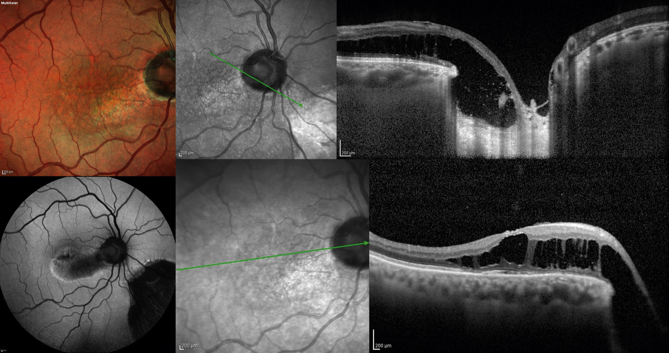 Foseta óptica… ¿de dónde procede el fluido retiniano? | Archivos de la ...