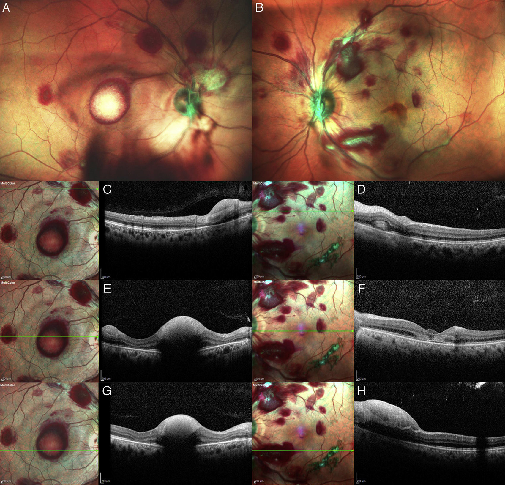 Retinopatía hemorrágica asociada a leishmaniasis visceral en el ...