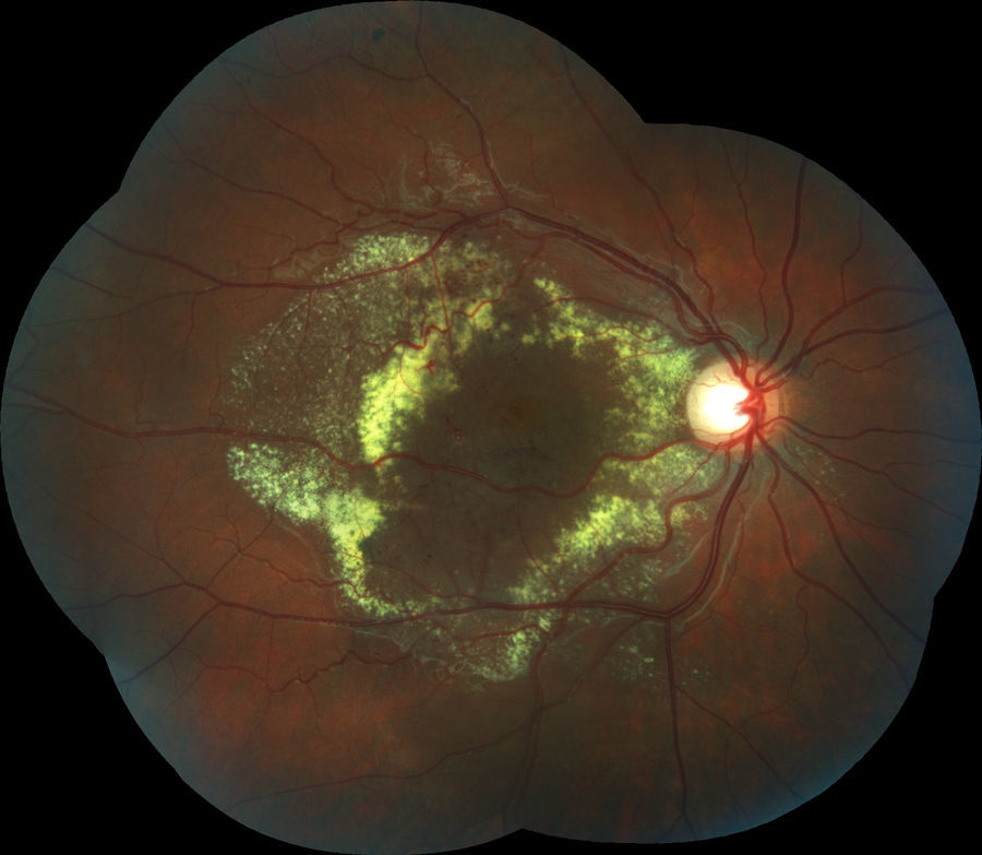 Enfermedad de Coats con edema macular sensible al aflibercept y láser ...