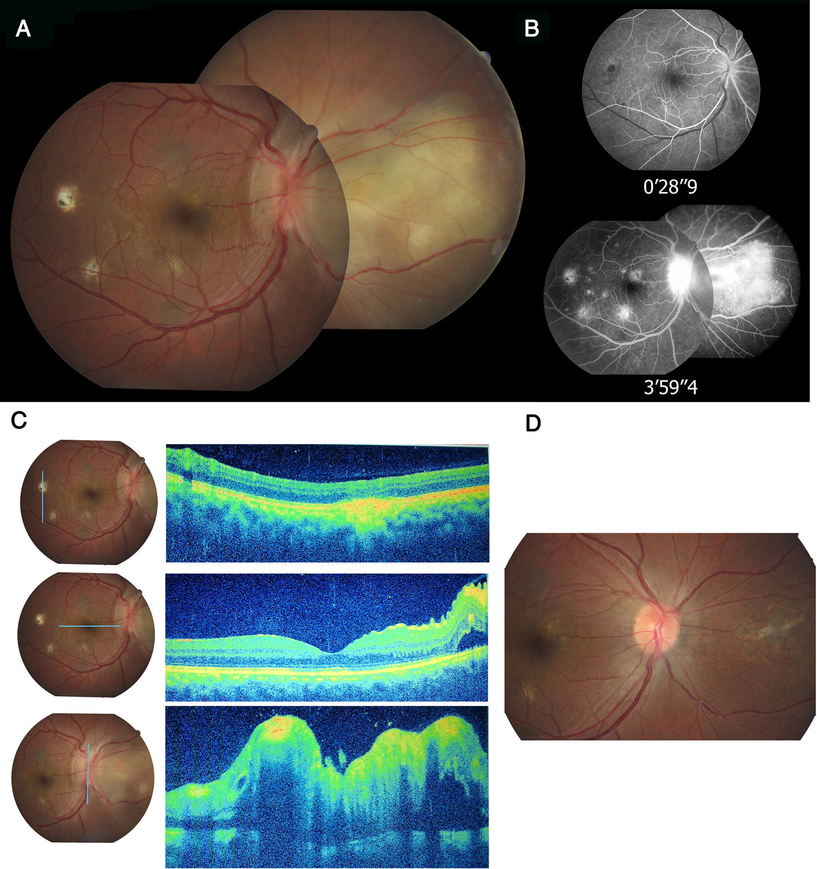 Tuberculosis intraocular | Archivos de la Sociedad Española de Oftalmología