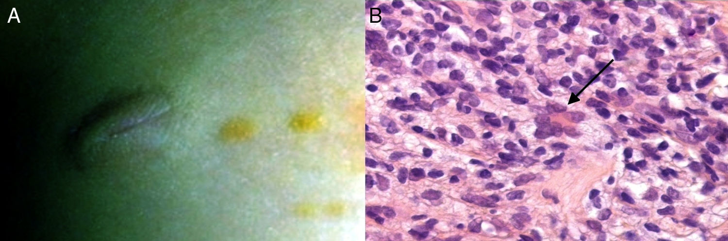 Glaucoma neonatal secundario a xantogranuloma juvenil: caso clínico ...
