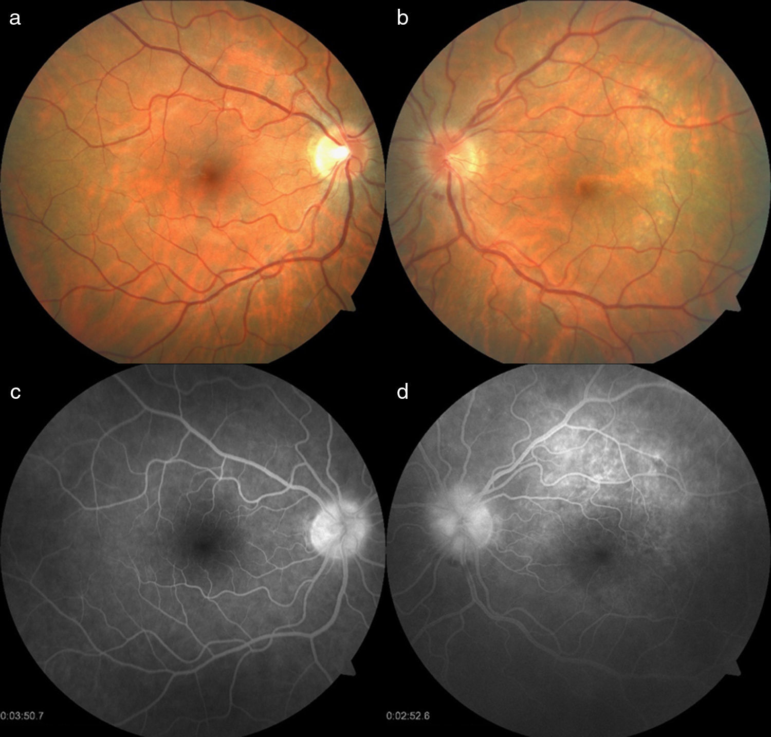 Coriorretinitis placoide posterior sifilítica como presentación inicial ...