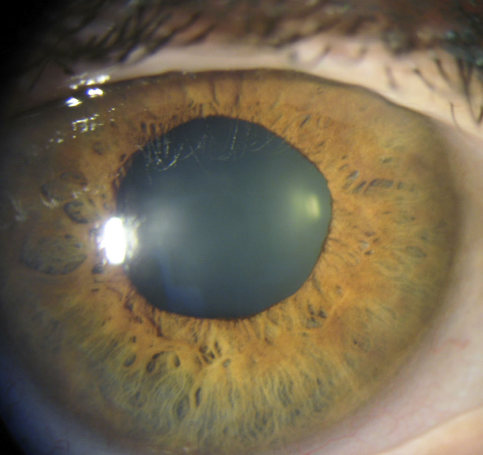 Síndrome de la transiluminación iridiana aguda bilateral. A propósito ...