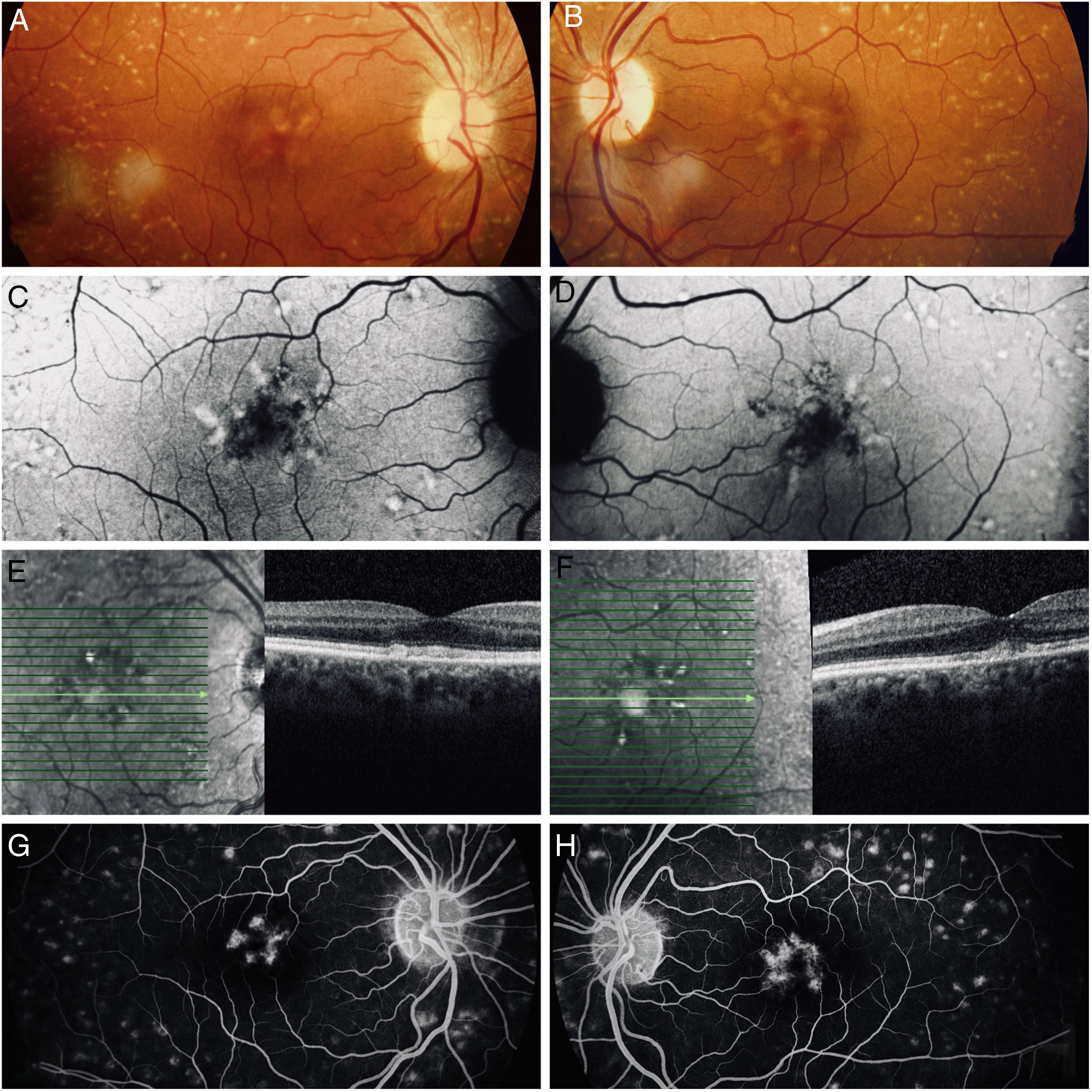 Imagen multimodal en el estudio del fundus flavimaculatus | Archivos de ...