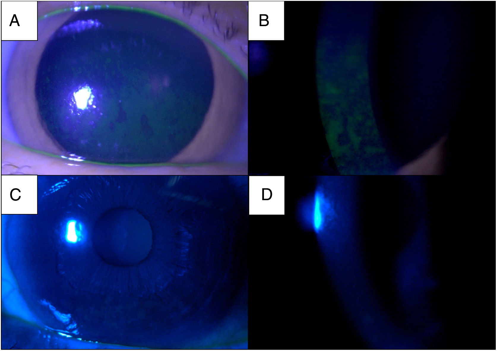 Aplicación de toxina botulínica en el músculo de Horner para el ...