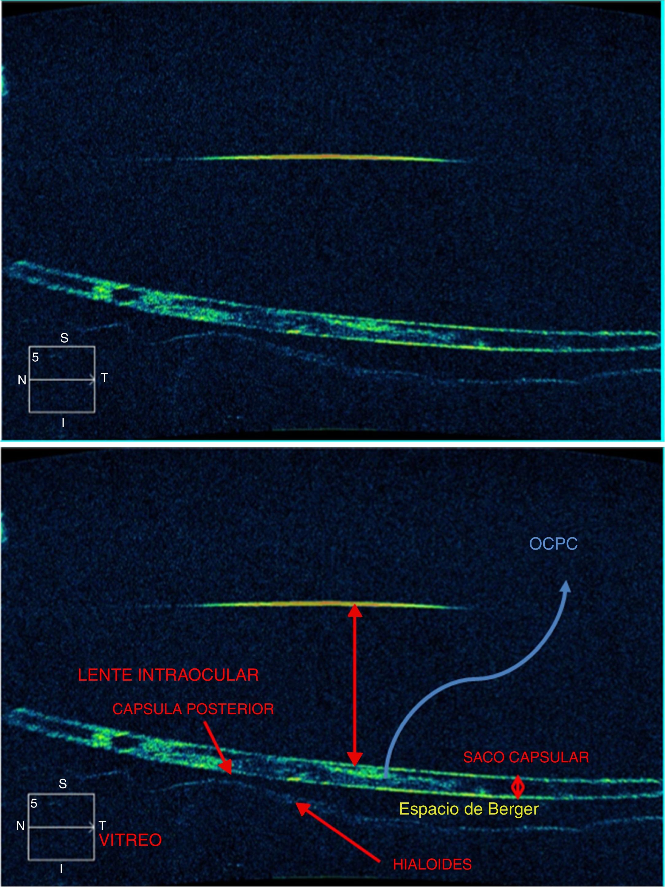 Espacio de Berger | Archivos de la Sociedad Española de Oftalmología