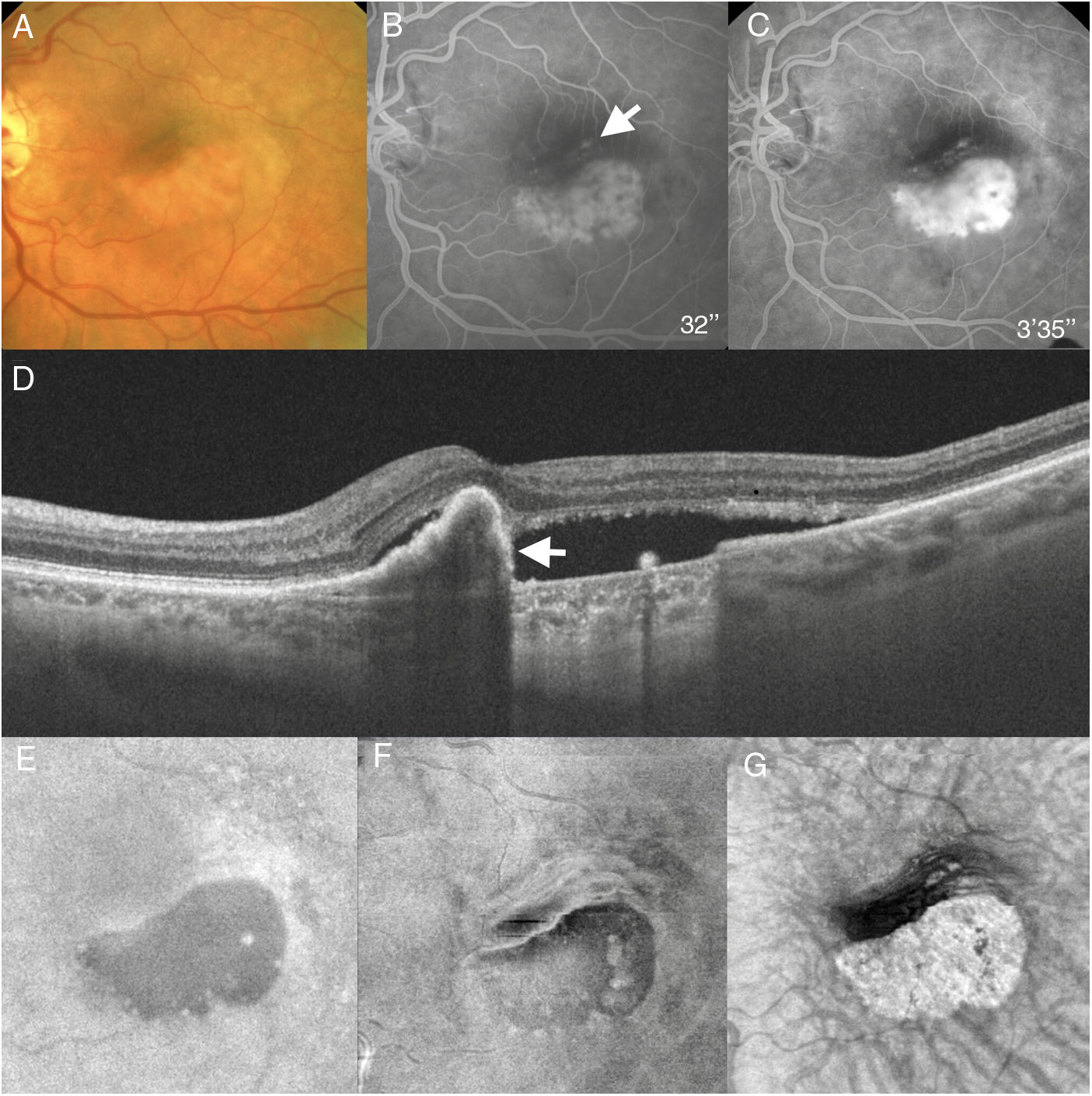 Uso de la OCT-en face en el diagnóstico de rotura del epitelio ...