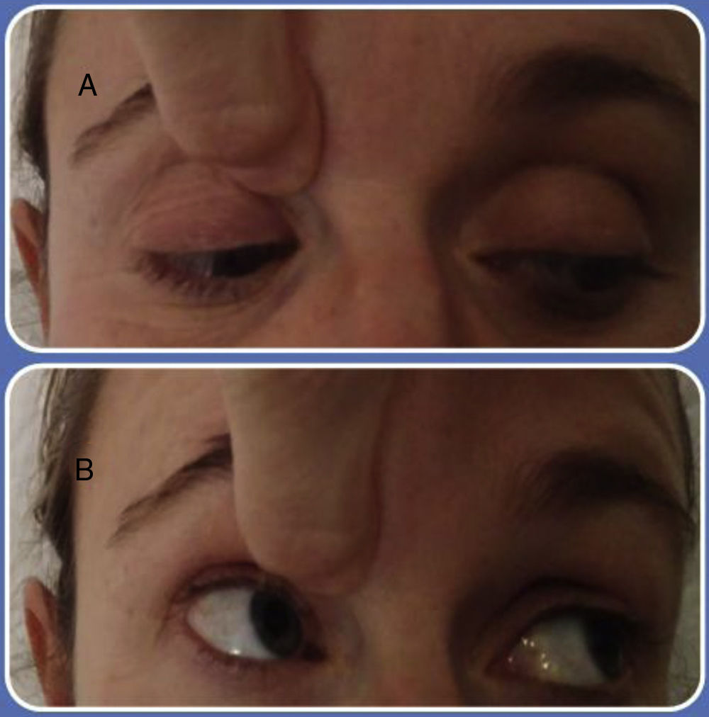 Cefalea troclear primaria. Un dolor periorbitario con diagnóstico y ...