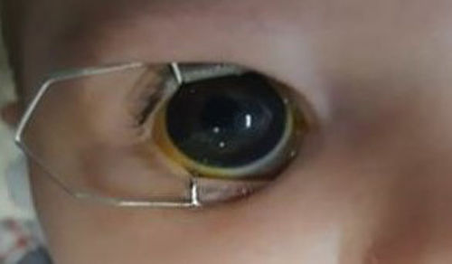 Megalocórnea esencial: relato de caso | Archivos de la Sociedad ...