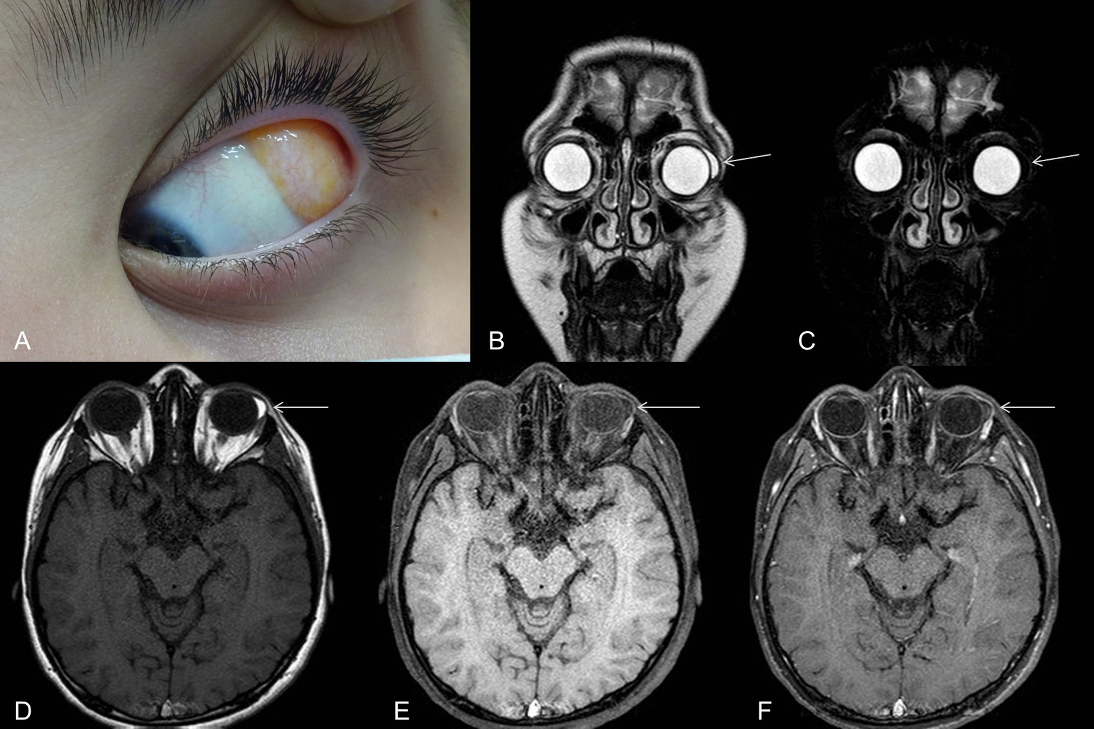 Dermolipoma conjuntival | Archivos de la Sociedad Española de Oftalmología