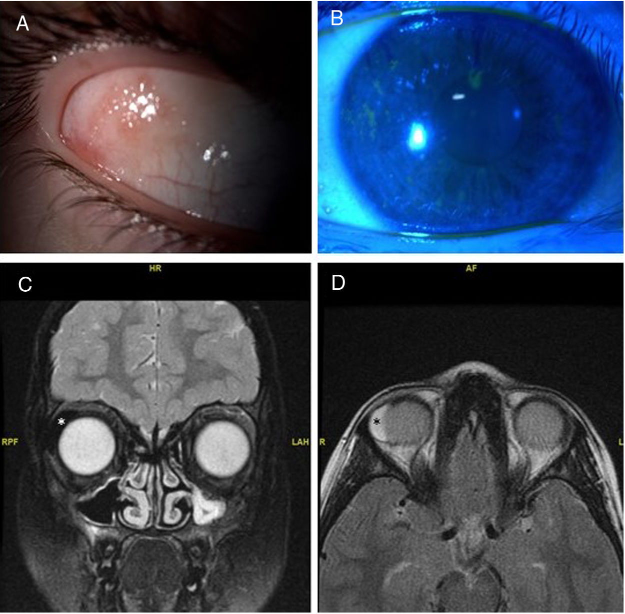 Agenesia unilateral congénita de glándula lagrimal con sustitución por ...