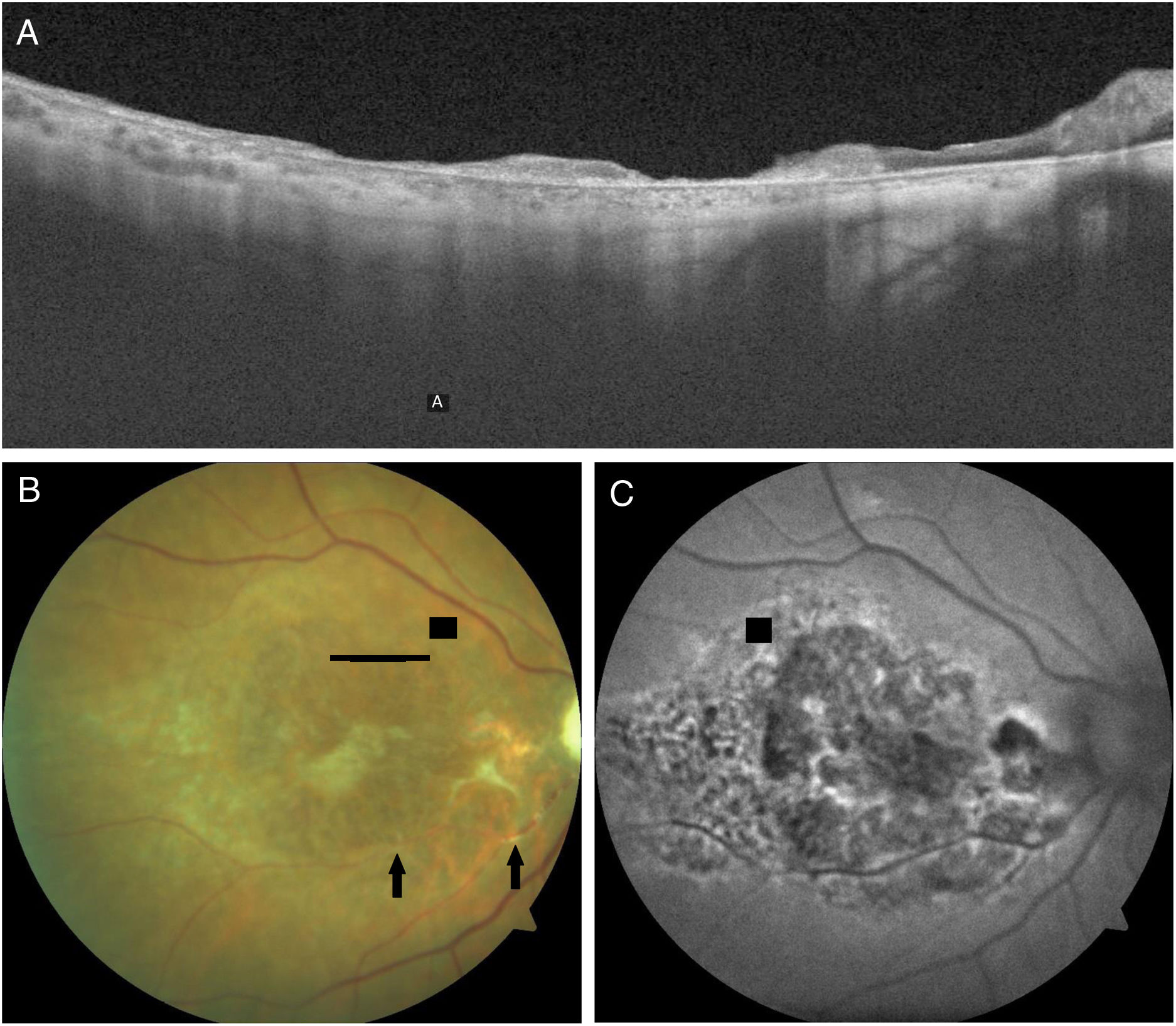 Retinitis necrosante crónica por citomegalovirus en una paciente con ...
